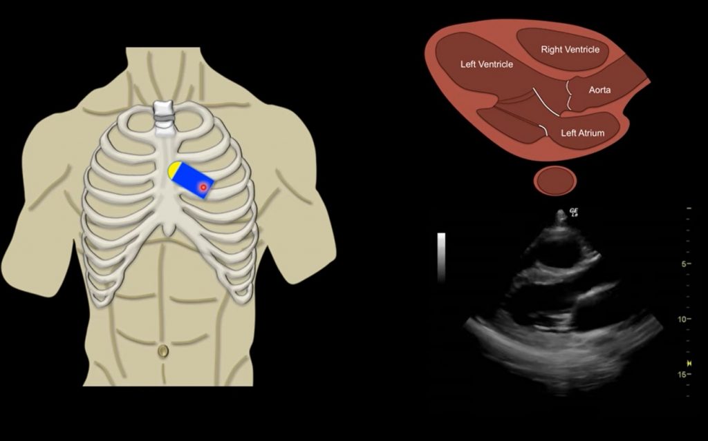 Identifying and Obtaining Standard Echocardiographic Views – Handbook ...