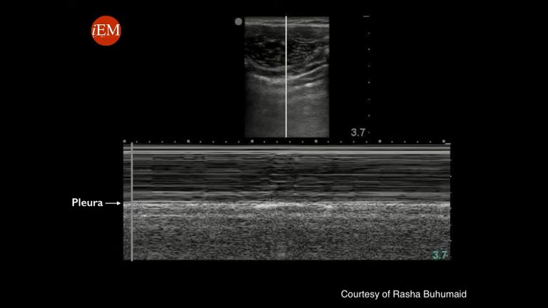 Key Signs and Interpretations in Lung Ultrasound – Handbook of Point of ...