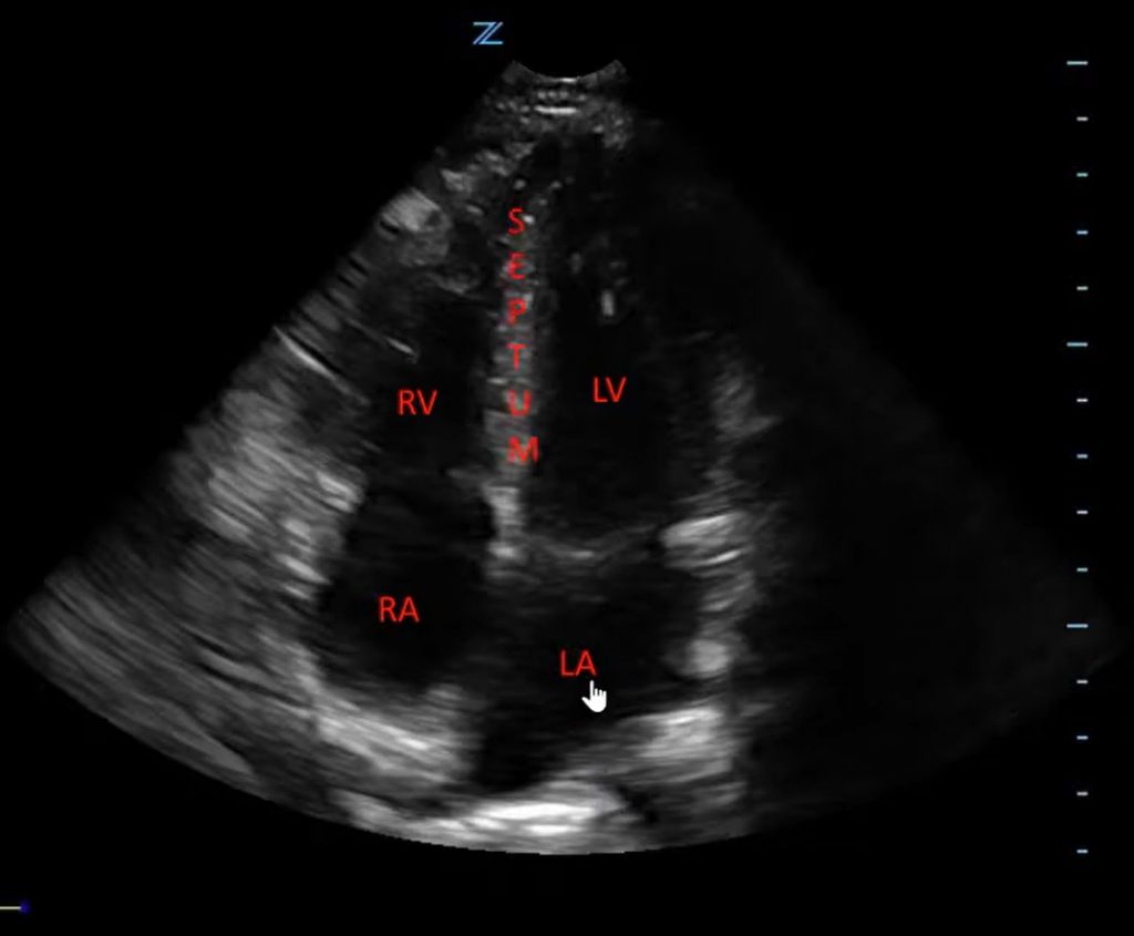 Identifying and Obtaining Standard Echocardiographic Views – Handbook ...
