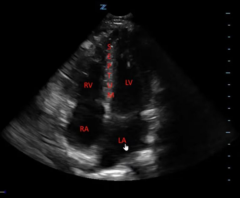 Identifying and Obtaining Standard Echocardiographic Views – Handbook ...