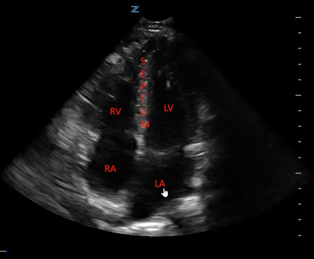 Identifying and Obtaining Standard Echocardiographic Views – Handbook ...