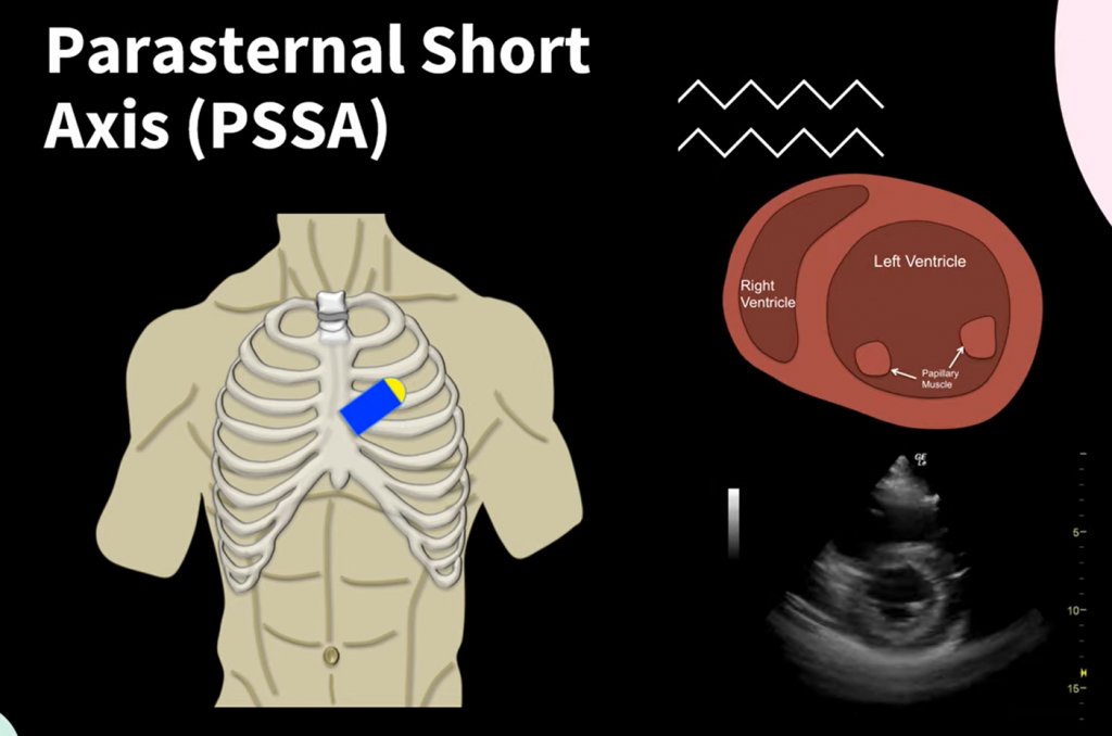 Identifying and Obtaining Standard Echocardiographic Views – Handbook ...