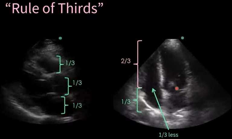 Identifying and Obtaining Standard Echocardiographic Views – Handbook ...